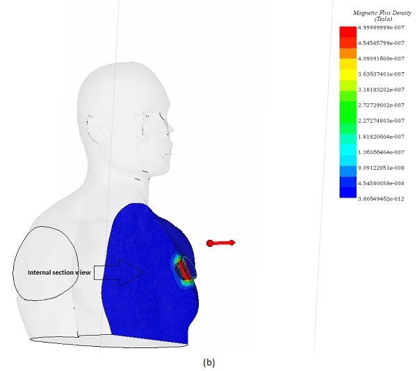 Wireless Power Transfer for Pacemakers | EMWorks